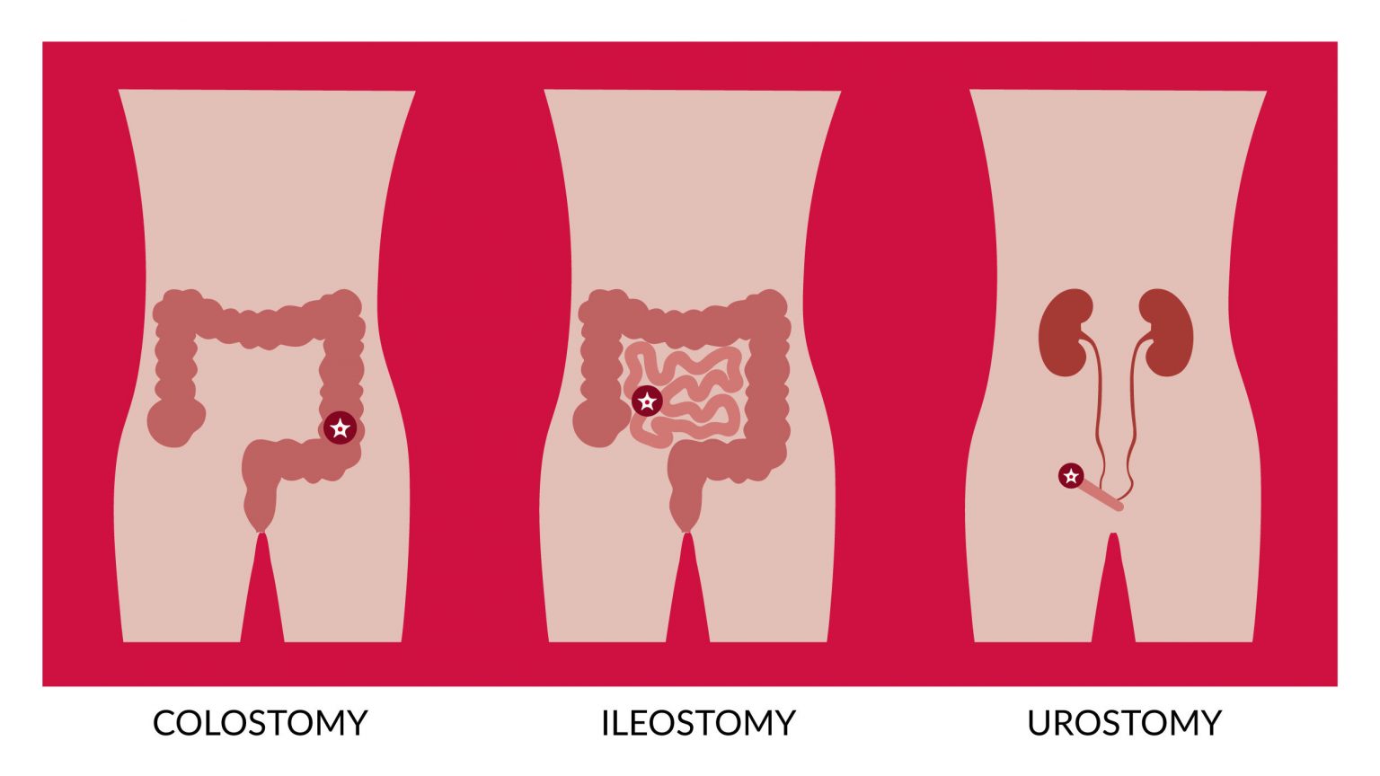 Colostomy Vs Ileostomy Vs Urostomy Trio Healthcare